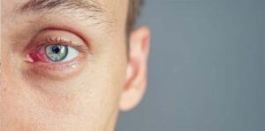 What Are the Symptoms of EzriCare Artificial Tears Contamination? | The ...